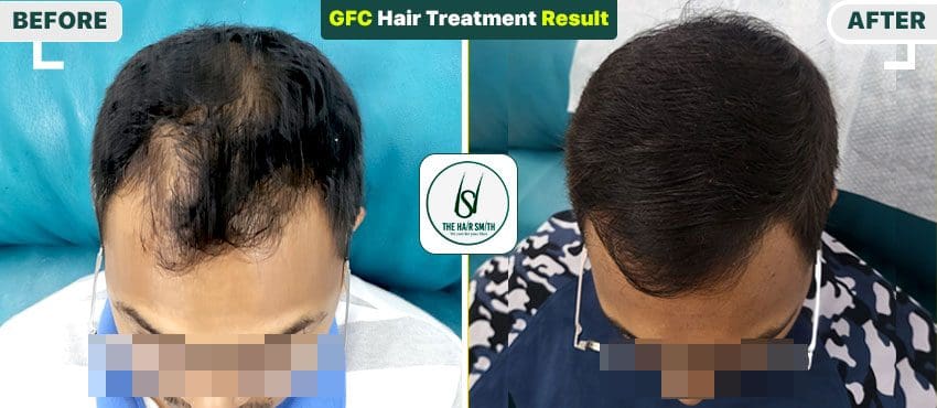 GFC Hair Treatment Delhi | Effective GFC Therapy Results